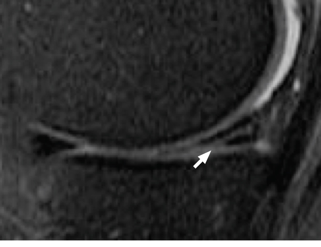 Meniscus FAQs Tears Repairs and Transplantation | Knee | Doctor ...